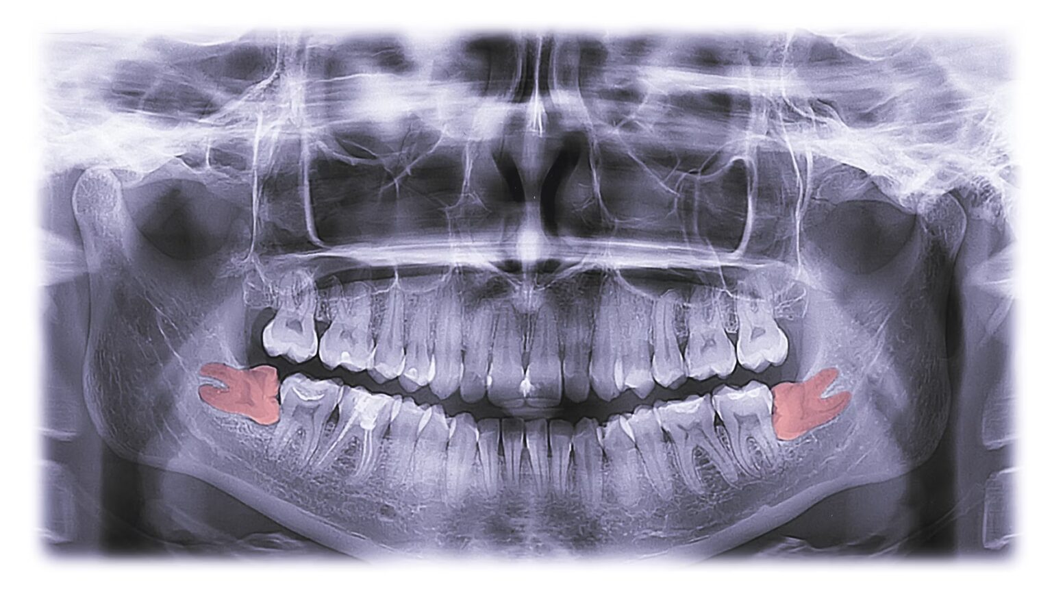 You should remove Wisdom Teeth. Here is why!
